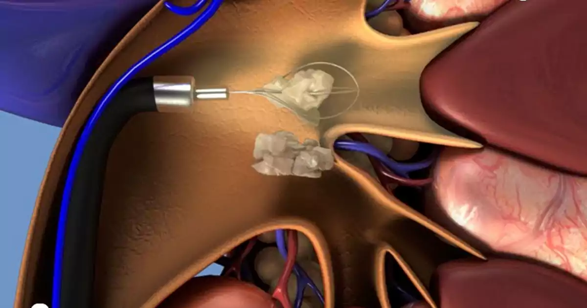 Dr. Dk. Mishra | Nephro - Urology & Stone Center